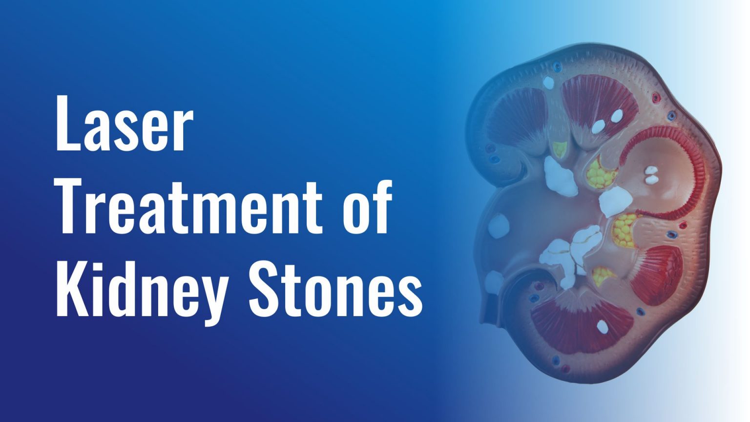 Laser Treatment of Kidney Stones – RIRS INDIA