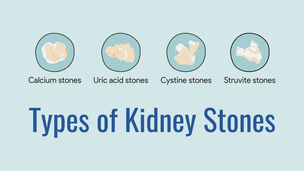 Types of Kidney Stones – RIRS INDIA